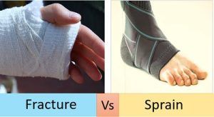 Difference Between Fracture and Sprain (with Comparison Chart) - Bio ...